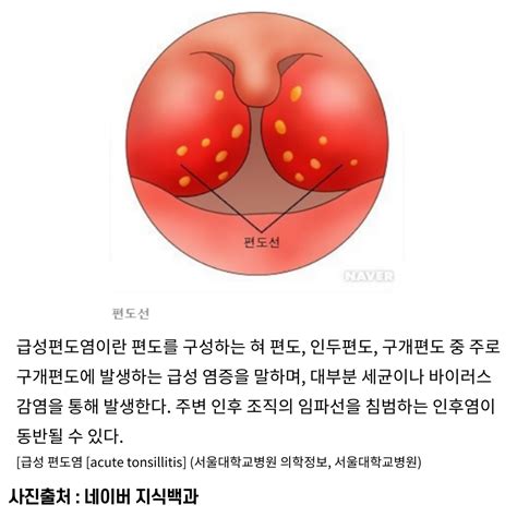 부었을 때 대처 방법 수술 급 성 편도선염 증상 플로깅