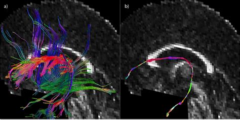 Figure 11 From Multi Fiber Tractography Visualizations For Diffusion