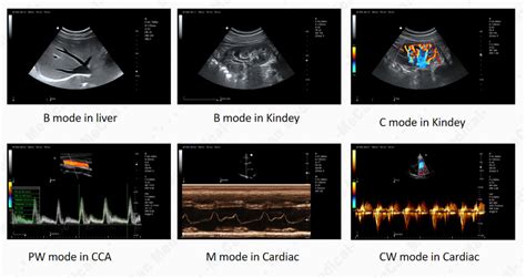 Full Digital Portable Mobile Echocardiography Cardiac Echo Ultrasound