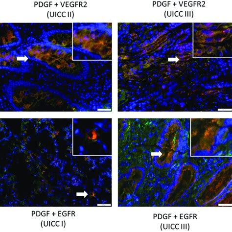Co Expression Of Pdgf With Vegfr2 And Egfr In Human Colon Cancer