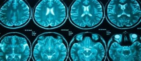 Stereotactic Radiosurgery For Brain Metastases And The Questionable Role Of Whole Brain
