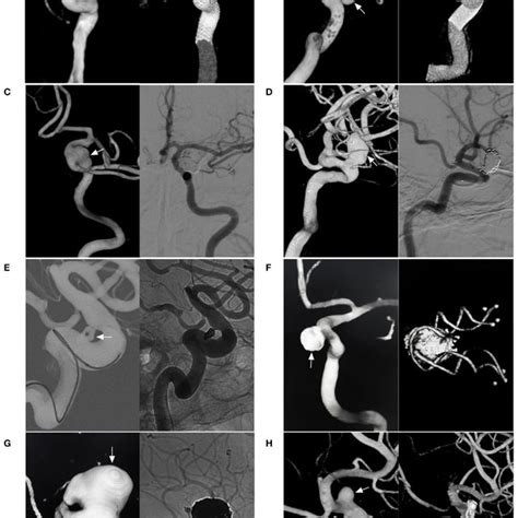 Figure E Nyu Paraophthalmic Segment Ab Cta A And Dsa Of The Ica