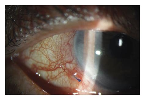 Complications After Intrascleral Fixation Of Intraocular Lens By The Download Scientific