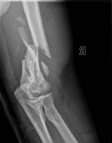 Comminuted Fracture X Ray