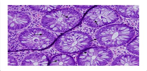 Image From Left Colon Multiple Glands Acini Seen With Intraepithelial Download Scientific