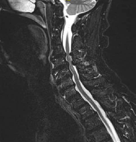 Case Study Anterior Cervical Discectomy Fusion Surgery