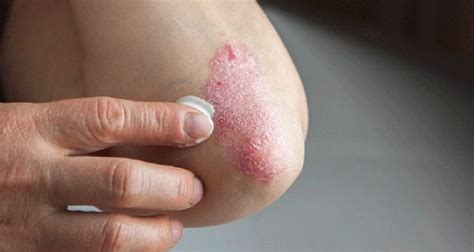 Bệnh Chàm Eczema Là Gì Triệu Chứng Nguyên Nhân Và Biện Pháp Phòng Ngừa