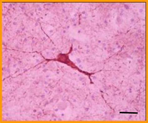 Microphotography Of A P‐gp Positive Dysplastic Neuron Detected In The Download Scientific