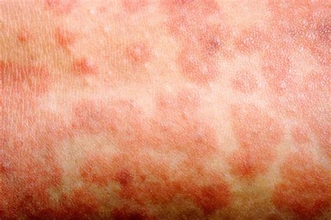 Measles Nhs