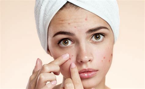 Acne o que é quais os tipos e as causas Augusta Matos Clínicas