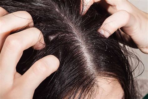 Macam Macam Dermatitis Yang Perlu Diketahui Apa Perbedaannya