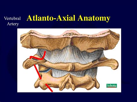 Ppt Upper Cervical Spine Fractures Powerpoint Presentation Free