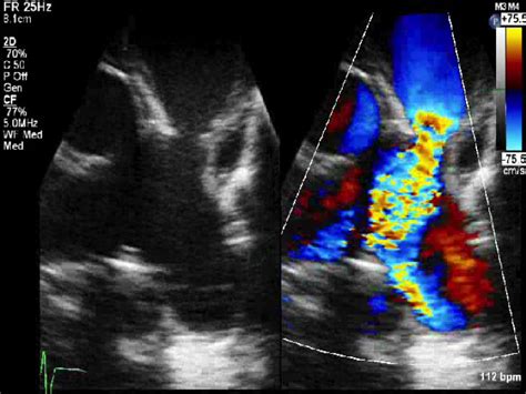Parasternal Short Axis Rvot Pv Pas Pediatric Echocardiography