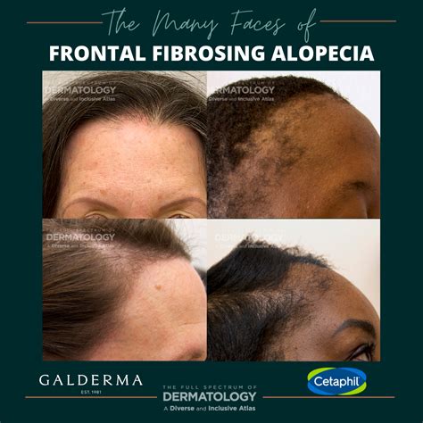 The Many Faces Of Frontal Fibrosing Alopecia Ffa Next Steps In