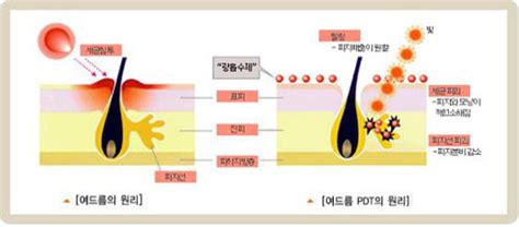못난이 캐릭터에도 여드름은 없다 Bnt뉴스