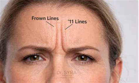 Vertical Forehead Lines 11 Lines Causes Treatments And Prevention