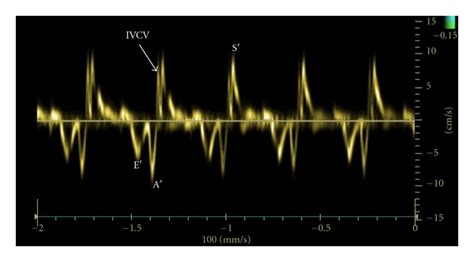 Tissue Doppler Derived Left Ventricular Longitudinal Myocardial Download Scientific Diagram