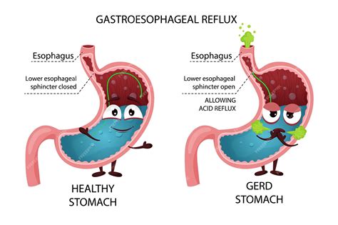 Premium Vector Happy Healthy Stomach And Sick Gastroesophageal Reflux