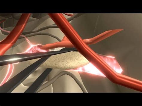 Trigeminal Neuralgia Pain Relieving Surgery YouTube