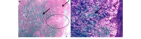 The Tissue Sections Were Stained With Picrosirius Red 950 And Viewed