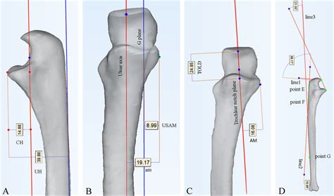 Measurement Of Coronoid Height CH And Ulnar Height UH A Download Scientific Diagram