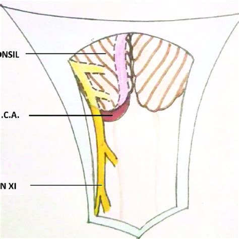 Diagrammatic Representation Of View After Subpial Resection Of The Left