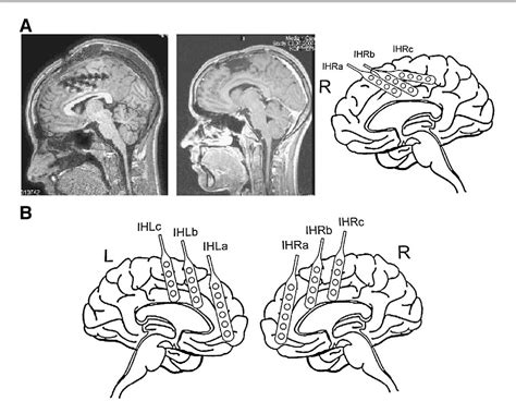 Figure 1 From Medial Frontal Cortex And Response Conflict Evidence From Human Intracranial Eeg