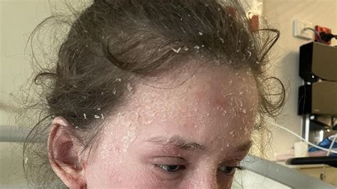 Eczema Summah Williams 11 Allergic To Her Own Tears Moogoo Eczema
