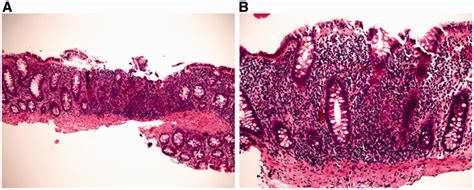 Infectious Colitis Typically Shows Acute Colitis Without Architectural