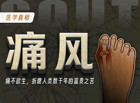 痛风：高速年轻化，九成尿酸高者肾有缺陷，如何科学改善？ 医学科普联盟 医学科普联盟 哔哩哔哩视频