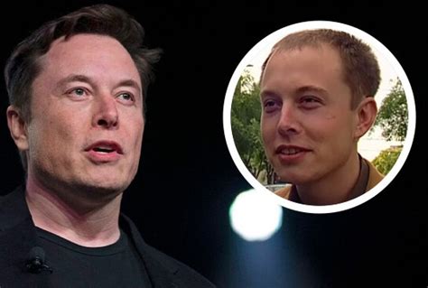 Elon Musk Before And After Hair Transplant Hair System