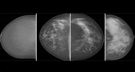 Höhere Krebsrate bei Frauen mit dichtem Brustgewebe