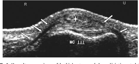 Figure From Ultrasound Findings In Injuries Of Dorsal Extensor Hood Correlation With MR And
