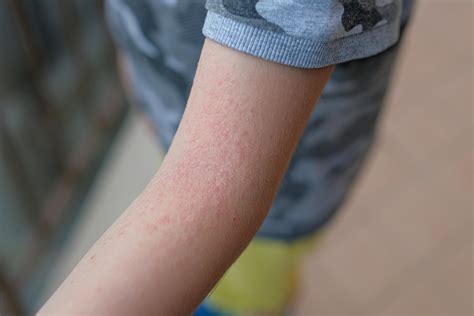 Eczema On Arms Eczema On The Arms Eczema Foundation