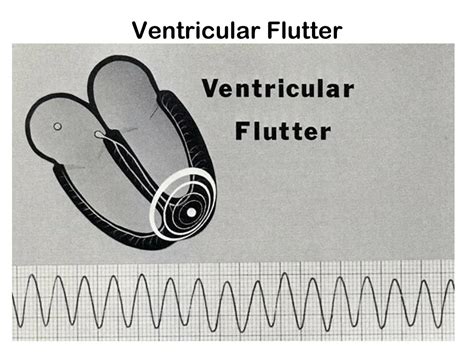 Ppt Expert Guide To Ekg Interpretation Rate Rhythm Hypertrophy