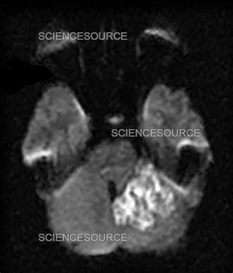 Posterior Fossa Epidermoid Tumor Stock Image Science Source Images