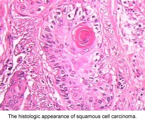 Squamous Cell Carcinoma Lung Keratin Pearls