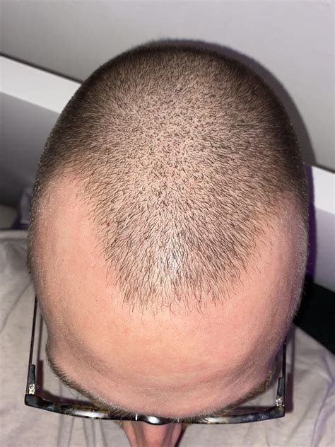 Just Minox And 05 Dermaroller Once A Week Almost 25 Months I Think