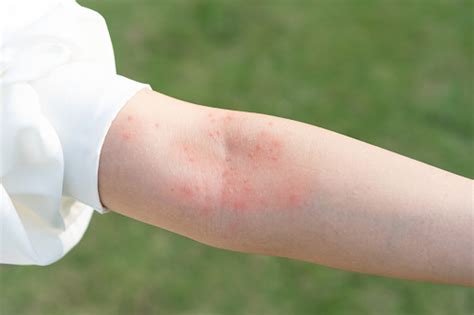 그녀의 피부를 가려워하는 여자 손의 클로즈업 알레르기 발진 피부염 습진 피부 곤충 음식 알레르기 건강 관리 개념 습진에 대한
