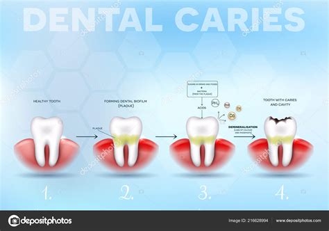 Dental Caries Formation Process At Angela Lewandowski Blog