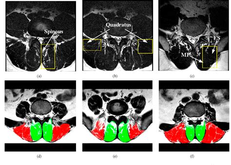 Figure 2 From Paraspinal Muscle Segmentation Based On Deep Neural Network Semantic Scholar