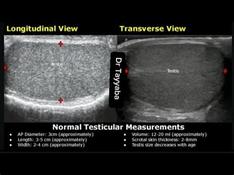 How To Measure Scrotum On Ultrasound Testes Epididymis AP Diameter Length Width Volume USG
