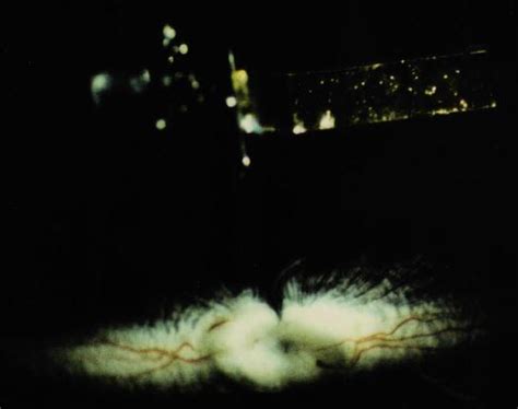 Development Of A Silicone Retinal Implant Surgical Methods And