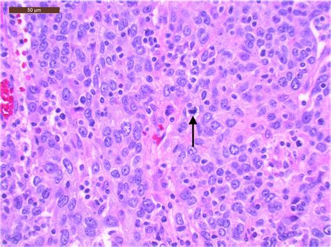 High Power View Of Atypia With Large Hyperchromatic Nuclei And Mitotic