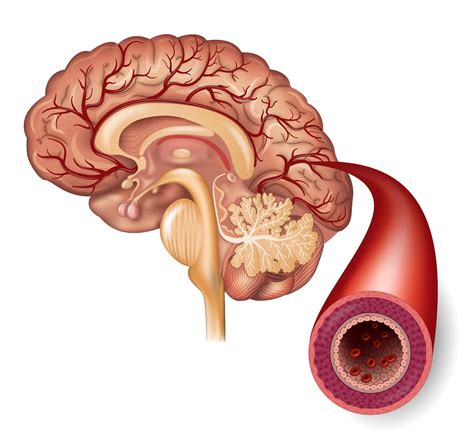 Mini Stroke Symptoms Tia Transient Ischemic Attack Sy