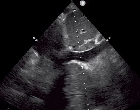 Rush Exam Ultrasound Protocol Step By Step Guide Pocus 101