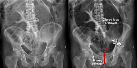 Volvulus Adalah