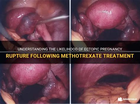 Understanding The Likelihood Of Ectopic Pregnancy Rupture Following Methotrexate Treatment