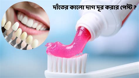 দাঁতের কালো দাগ দূর করার পেস্ট