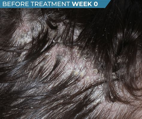 See Zoryve Results Zoryve® Roflumilast Topical Foam 0 3